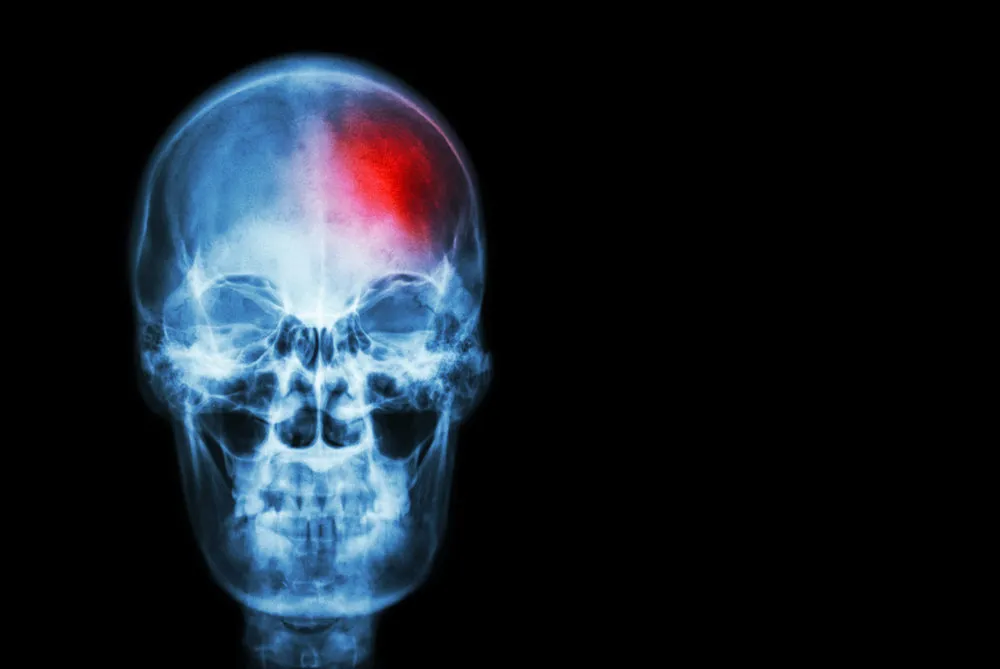 Traumatic Brain Injuries – Concussions: What Are They ...