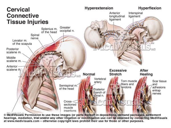 Whiplash Neck Muscles Involved Clătită Blog